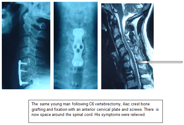 Cervical vertebrectomy